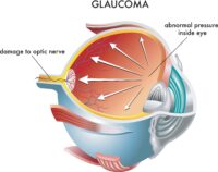 How Quickly Does Glaucoma Progress? | Eye Care Professionals