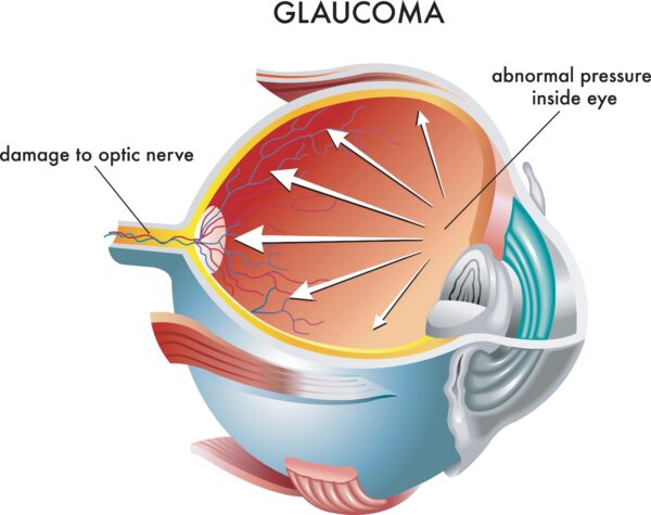 How Quickly Does Glaucoma Progress? | Eye Care Professionals