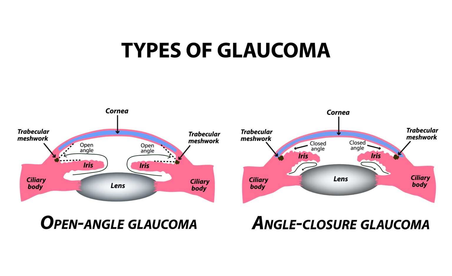 How Quickly Does Glaucoma Progress? | Eye Care Professionals