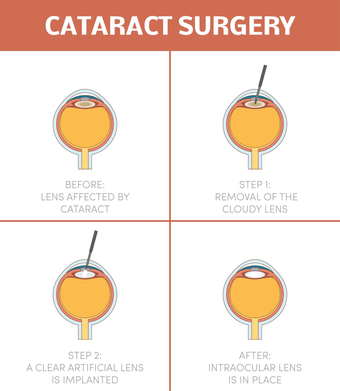 The 4 Types of Cataract Lenses | Eye Care Professionals