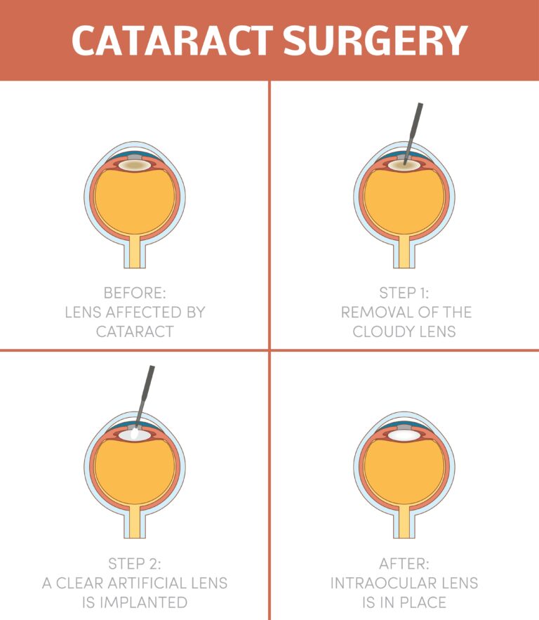The 4 Types of Cataract Lenses | Eye Care Professionals