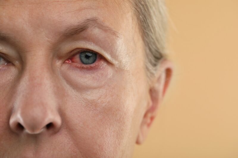 Conjunctivitis vs Blepharitis: Understanding the Differences | Reno Eye ...